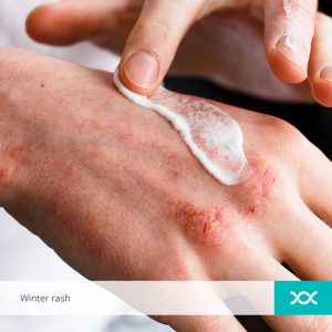 » How to prevent and treat both winter rash and ashy skin
